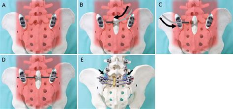 Less Invasive Lumbopelvic Fixation Technique Using A Percutaneous Pedicle Screw System For