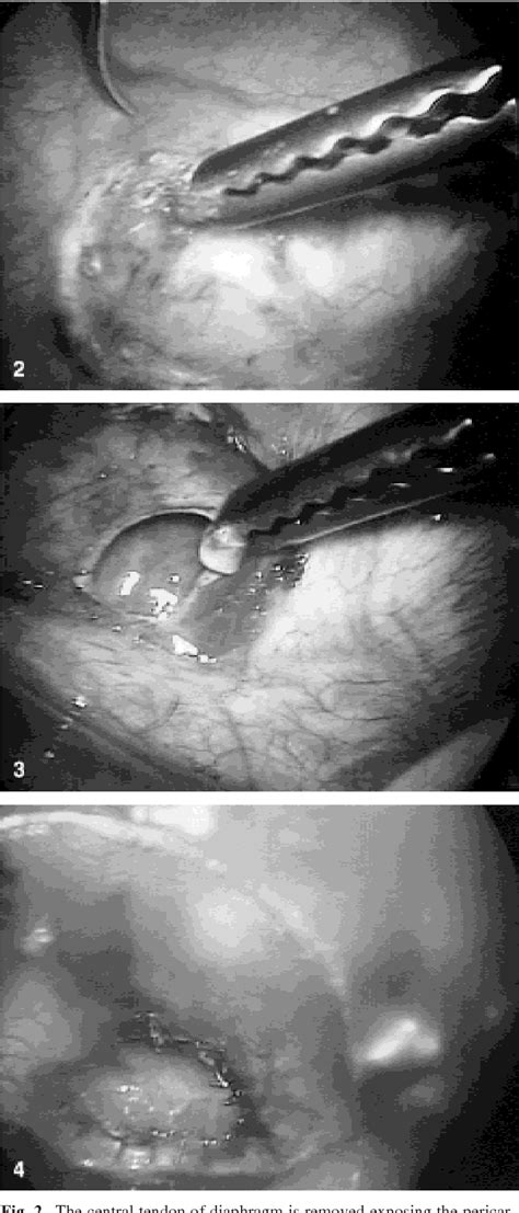 Figure 2 From Pericardio Peritoneal Window Laparoscopic Approach