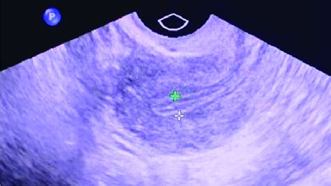 Endometrial Thickness Ultrasound