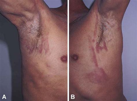 Interstitial Granulomatous Dermatitis With Cutaneous Cords And
