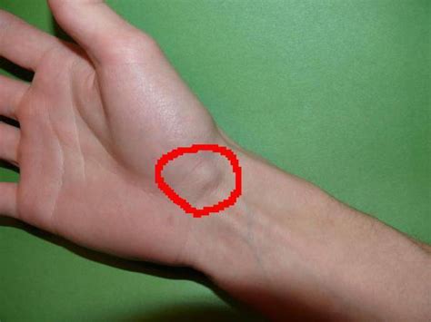 Твердые Шишки Под Кожей Фото —