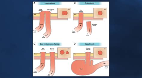 Ileostomy Diagram