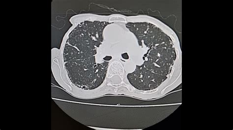 Hrct Chest Of A Case Of Scleroderma Youtube