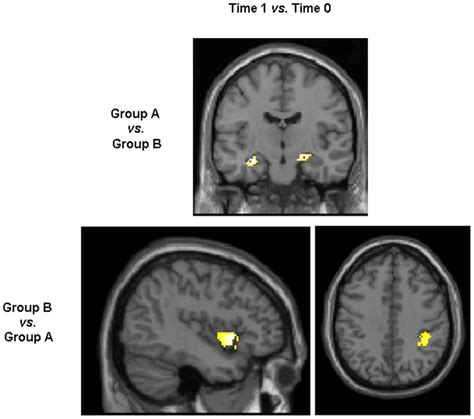 Statistical Parametric Mapping Spm Regions Superimposed On Download Scientific Diagram