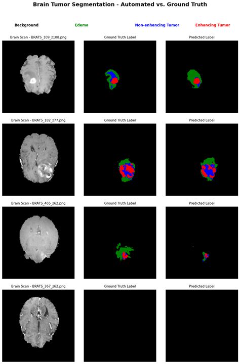 Brain Tumour Image Segmentation Cnn Home