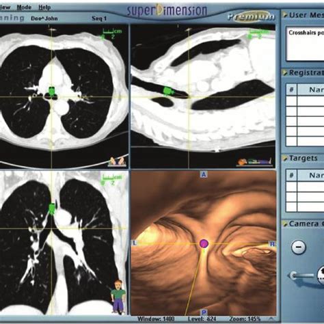 Pdf Electromagnetic Navigation Guided Bronchoscopy