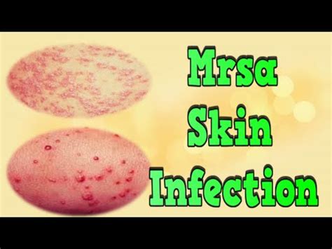 Early Mrsa Rash