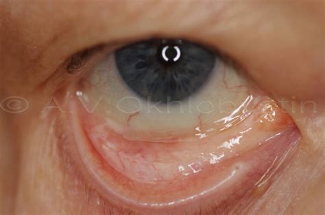 Identify The Redness In An Image And Then Compare With The Other Image Using Matlab Stack Overflow