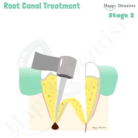 Root Canal Treatment Happy Dentists