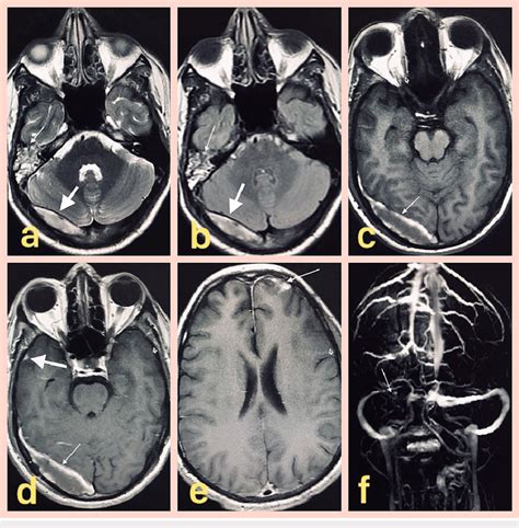 Axial T2wi T2 Flair T1 Non Contrast T1wi Post Contrast 3d Tof Mrv