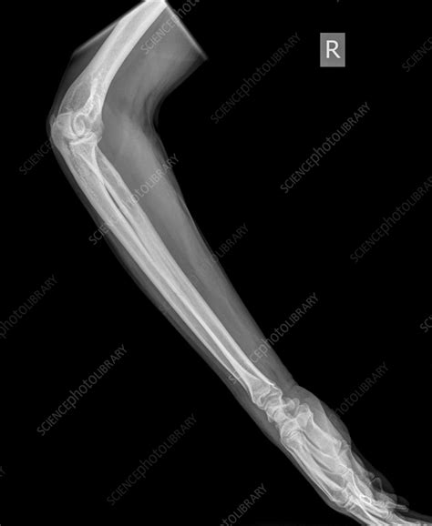 Distal Radius Fracture X Ray Stock Image C056 4173 Science Photo