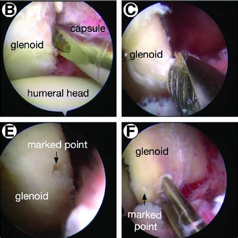 Glenoid Preparation An Arthroscopic Right Shoulder View Through Portal Download Scientific