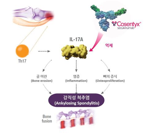 코센틱스® 강직성 척추염 건선성 관절염 치료 5년 장기 데이터 발표