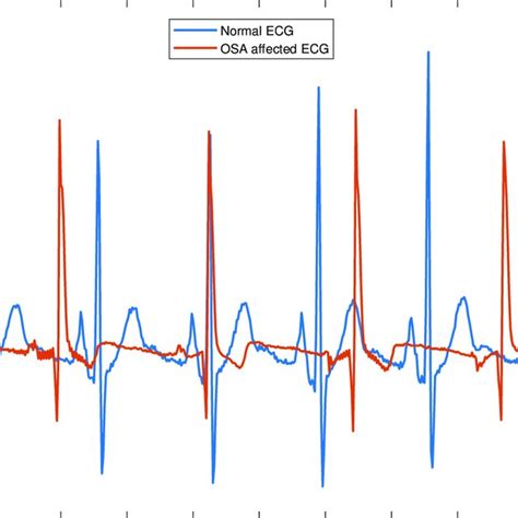 Pdf Diagnosis Of Obstructive Sleep Apnea From Ecg Signals Using