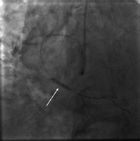 Complete Expansion Arrow Of 3 0 × 12 Mm Shockwave Intravascular Download Scientific Diagram