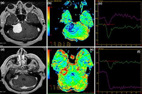 Two Cpa Tumors T1 Post Contrast A D Images Cbv Maps B E And