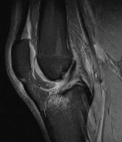 Torn Acl Mri