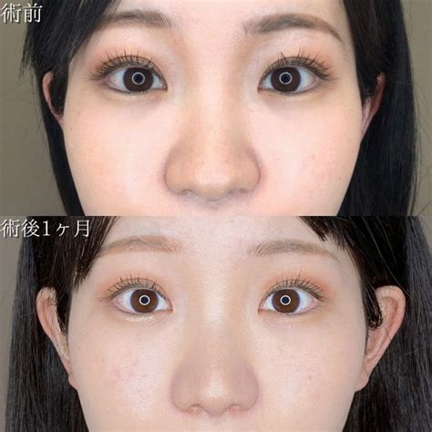 症例写真 ：鼻尖形成 美容整形はtcb東京中央美容外科