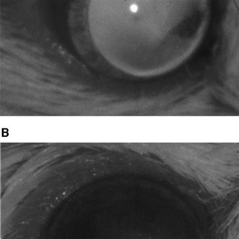 Clinical Photographs Showing Pseudohypopyon Lymphoma Infiltration In