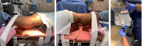 Anesthetic And Surgical Considerations For Staged Bilateral
