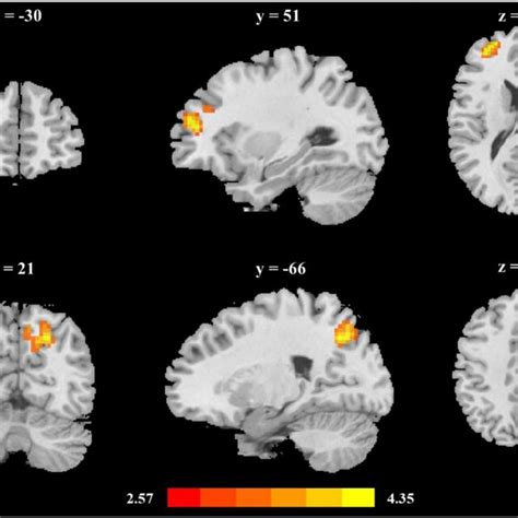 The Two Cortico Subcortical Reading Pathways A Reading Ability Was