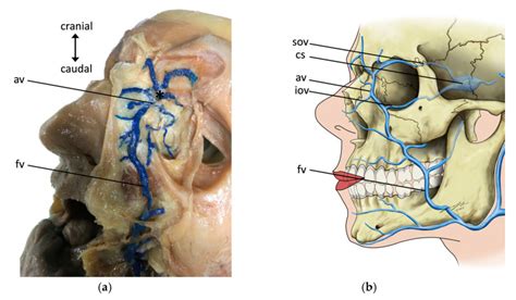 New Insights Into The Communications Of The Facial Vein With The Dural