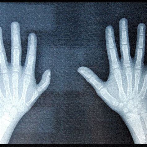 X Ray Of The Hands Demonsrated Left Side Hypoplastic Thumb Type Iiib