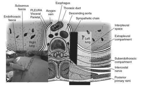Ultrasound Guided Thoracic Paravertebral Block Nysora