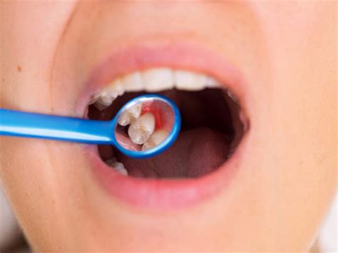 Gingivitis Dental Brackets