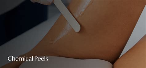 Genital Acne Scar Causes Treatments Prevention