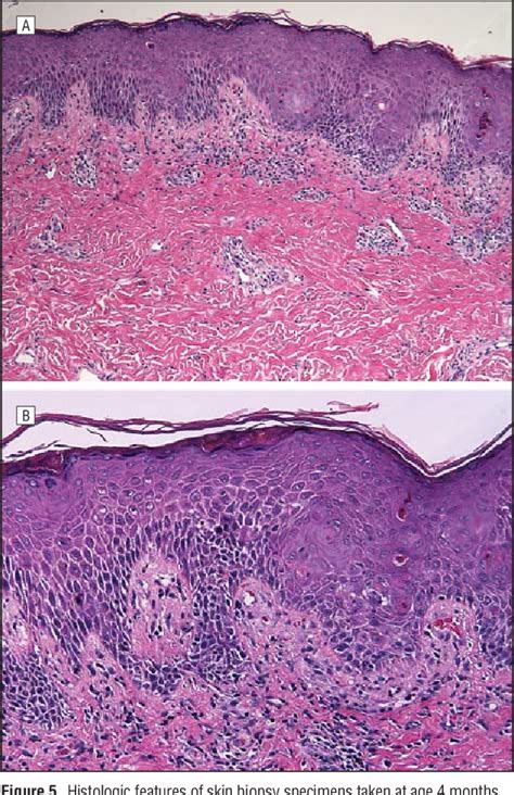 Figure 2 From X Linked Ectodermal Dysplasia With Immunodeficiency Caused By Nemo Mutation Early