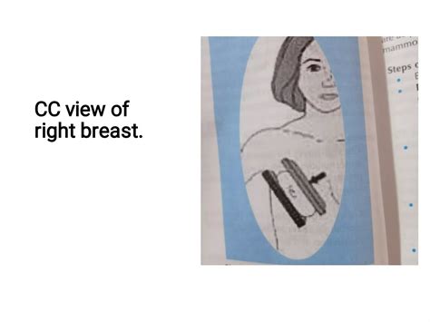 Mammography Radiologypdf