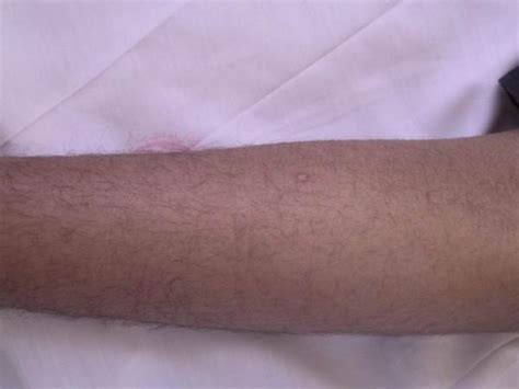 An Anetodermic Lesion On Forearm Download Scientific Diagram