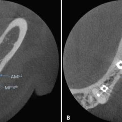 Grading System For Bone Quality Assessment Lekholm And Zarb 1985 In Download Scientific