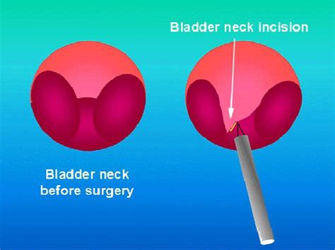Bladder Neck Incision Melbourne Bni West Melbourne — Homi Zargar