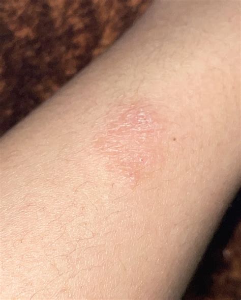 Is This Ezcema Ive Never Gotten It Before Rdermatologyquestions