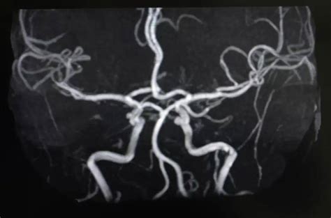 【健康医声】cta、mra、dsa分不清楚， 一文带你搞懂三种关于a”的检查血管成像优缺点