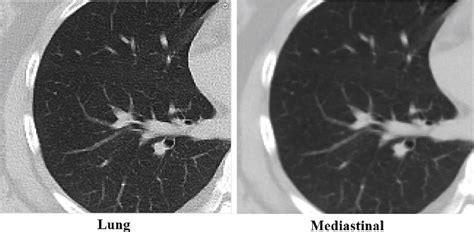 Examples Of Two Types Of Thick Slice Lung Ct Images Left Image Download Scientific Diagram