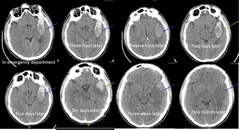 Brain Ct Showing The Left Temporal Epidural Hemorrhage And Its