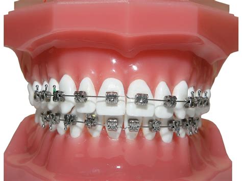 Types Of Braces