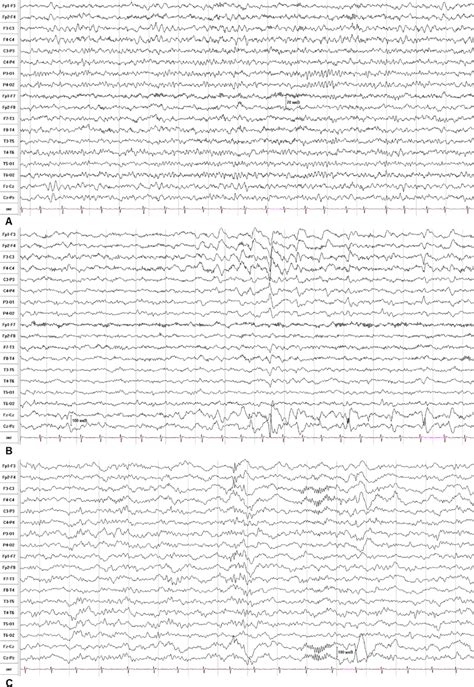 Eeg Of Patient 2 During Wakefulness And Sleep A Waking Eeg Download Scientific Diagram