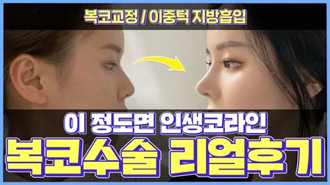 복코수술 이게 바로 자연스러운데 화려한 코💖│비포 애프터│리얼후기│버블tv Youtube