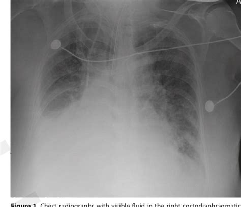 Figure 1 From A Case Of Exudative Pleuritis Caused By Staphylococcus Warneri Semantic Scholar