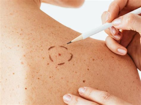 首款实体瘤细胞疗法！amtagvi在美获得加速批准用于晚期黑色素瘤 知乎