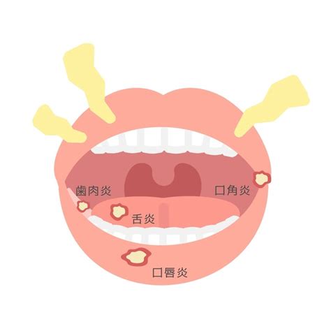 5 Angular Estomatitis Stock Vectors And Vector Art Shutterstock