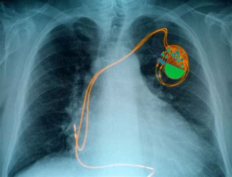 Biological Pacemaker Keeps A Beat Without The Hardware New Scientist