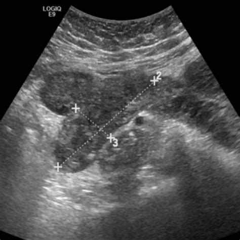 Case Reports Of Imaging Of Postpartum Ovarian Vein Thrombosis Eurorad