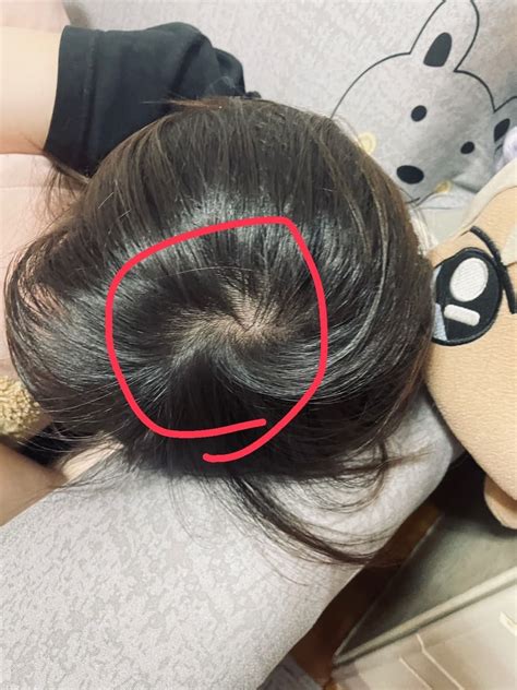請問這樣算禿頭前兆嗎？ 美髮板 Dcard
