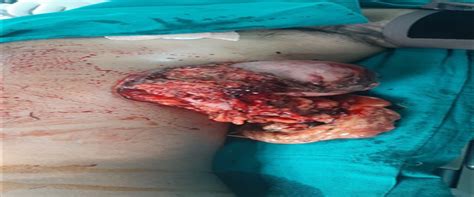 Evisceration Of Intestines With Diaphragmatic Laceration And