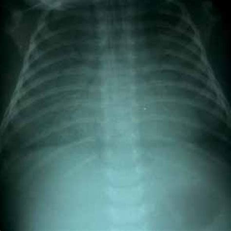 Diffuse Bilateral Ground Glass Opacities Were Evident On Chest X Ray Download Scientific Diagram